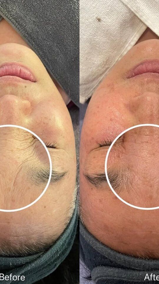 TRIUM l Dual Laser Skincare Platform